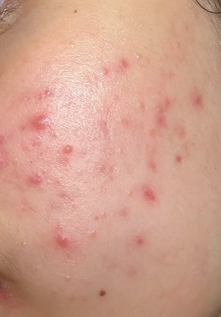 Bayer Skinoren 20% Cream (Ingredients Explained)