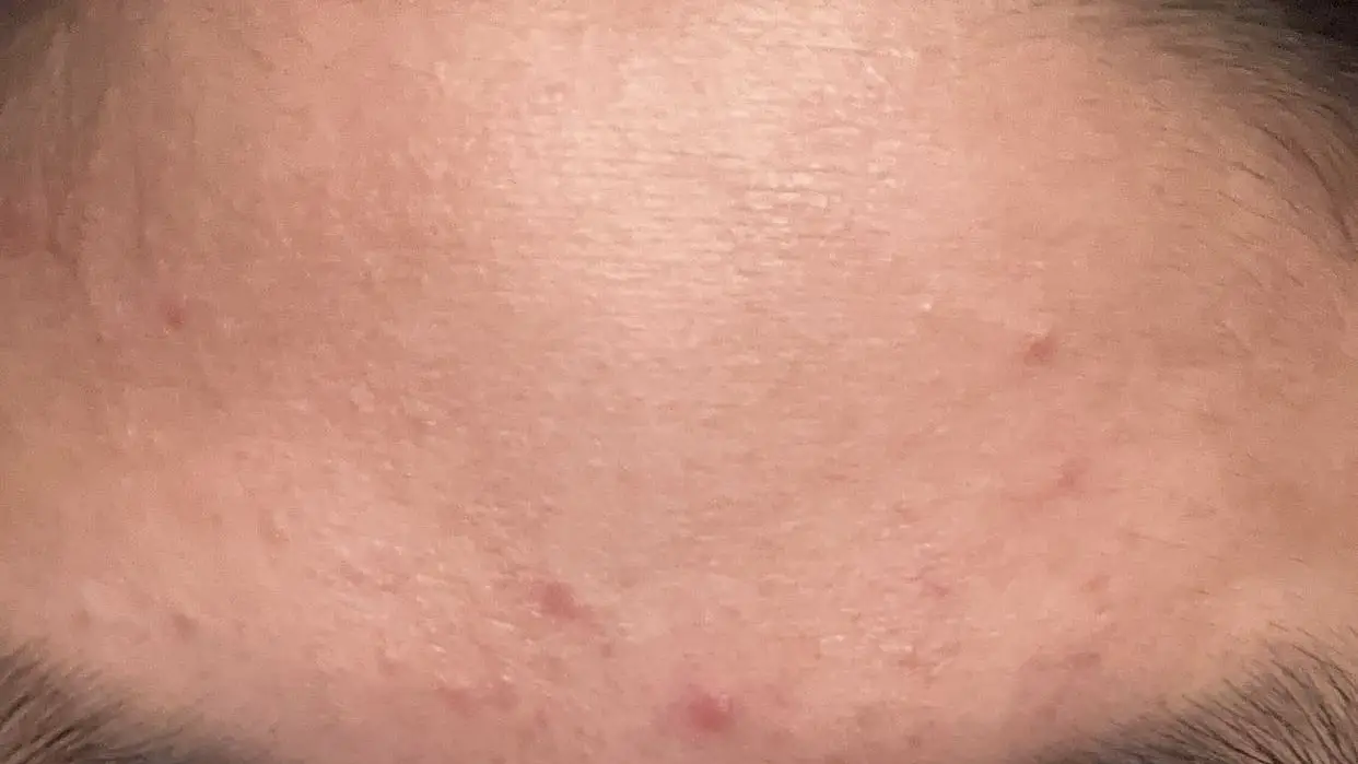 REFY Face Sculpt VS Blume Meltdown Gel Cream for Acne-Prone Skin